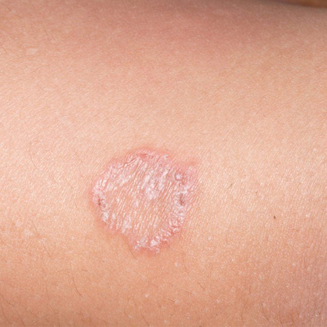 Hvad er ringorm og hvordan smitter det? | ShytoBuy